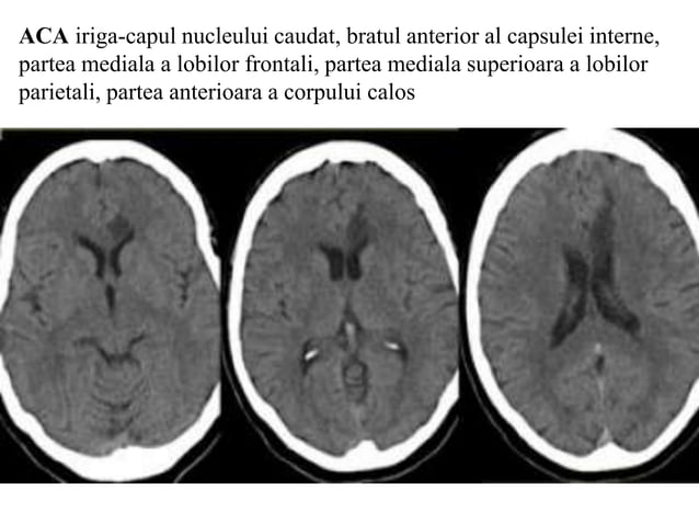 Examinarea CT cerebrala-AVC ischemic.pptx
