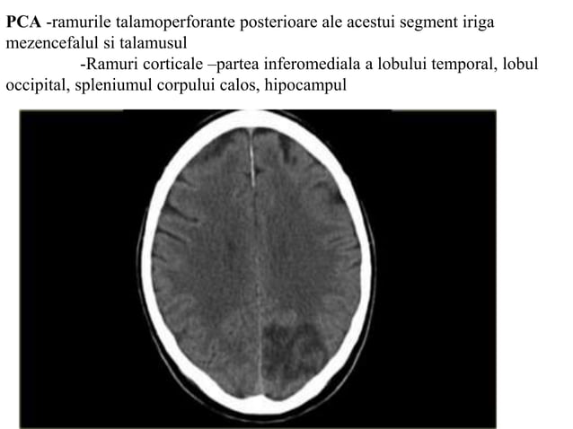 Examinarea CT cerebrala-AVC ischemic.pptx