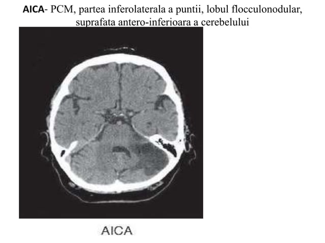 Examinarea CT cerebrala-AVC ischemic.pptx