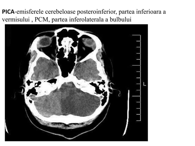 Examinarea CT cerebrala-AVC ischemic.pptx