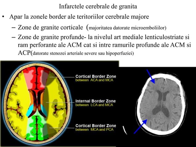 Examinarea CT cerebrala-AVC ischemic.pptx