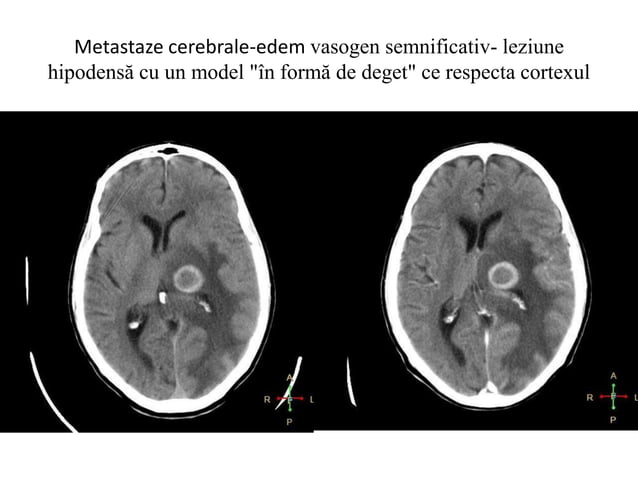 Examinarea CT cerebrala-AVC ischemic.pptx