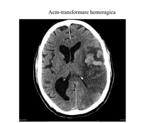 Examinarea CT cerebrala-AVC ischemic.pptx