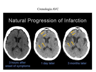 Examinarea CT cerebrala-AVC ischemic.pptx