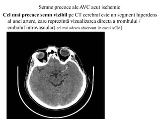 Examinarea CT cerebrala-AVC ischemic.pptx