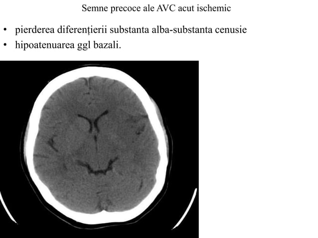 Examinarea CT cerebrala-AVC ischemic.pptx