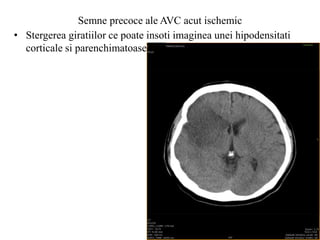 Examinarea CT cerebrala-AVC ischemic.pptx
