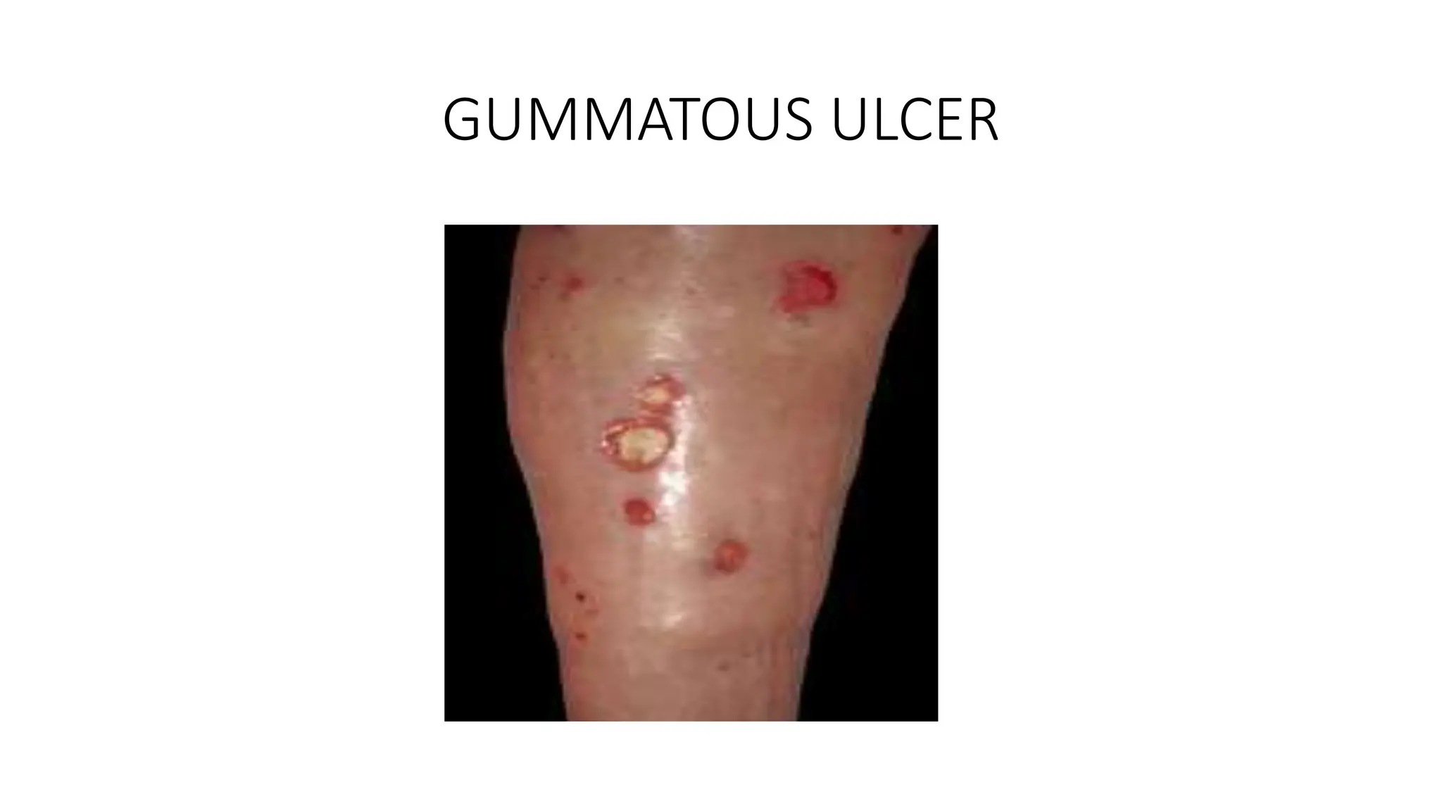 EXAMINATION AND CLINICAL APPROACH OF AN ULCER.pptx