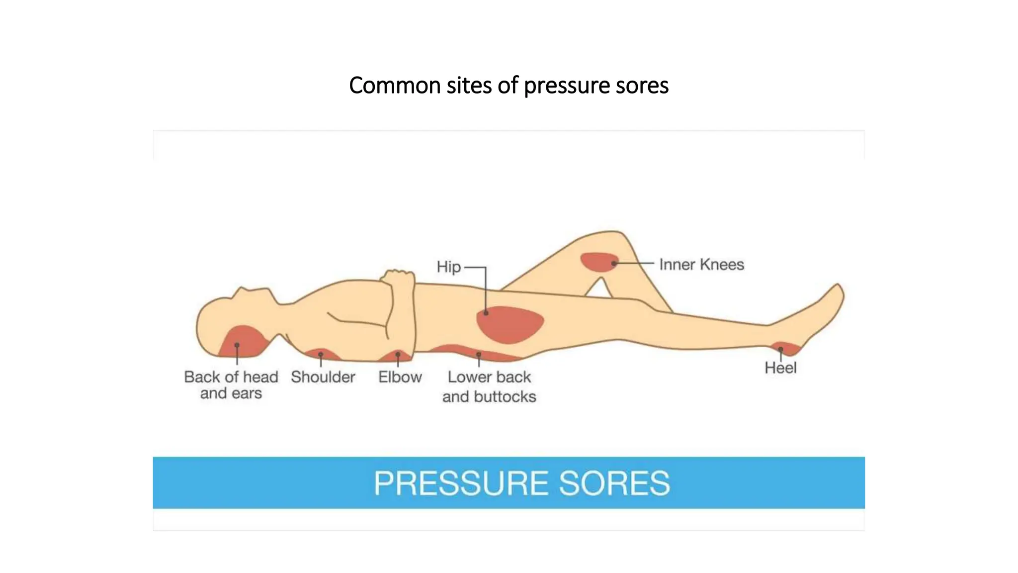 EXAMINATION AND CLINICAL APPROACH OF AN ULCER.pptx