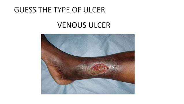 EXAMINATION AND CLINICAL APPROACH OF AN ULCER.pptx