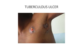 EXAMINATION AND CLINICAL APPROACH OF AN ULCER.pptx