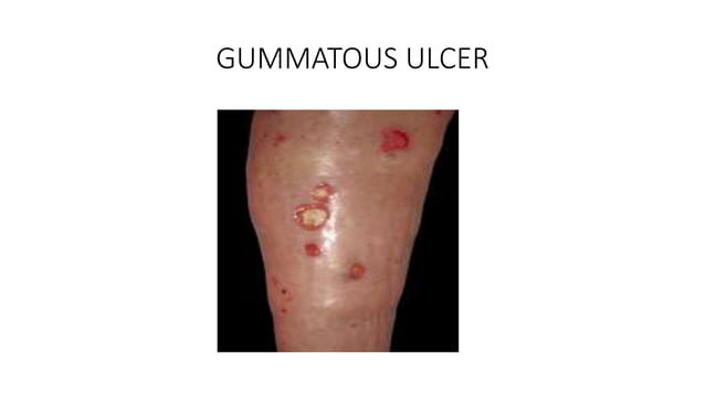 EXAMINATION AND CLINICAL APPROACH OF AN ULCER.pptx