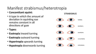 Examination in strabissmus (1).pptxdsfedf | PPTX