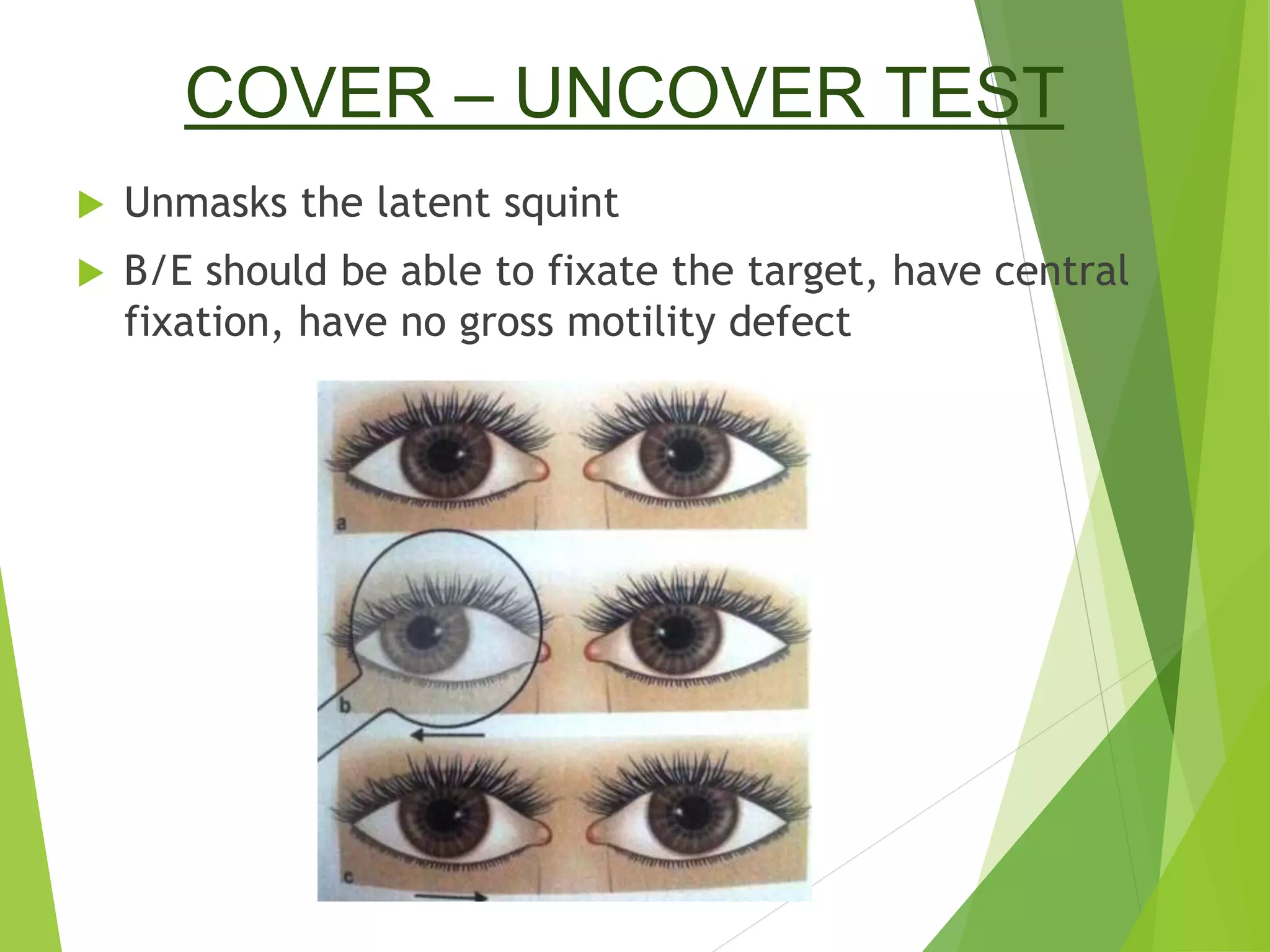 Examination of a case of squint | PPTX