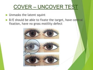 Examination of a case of squint | PPTX | Eye and Vision Conditions ...