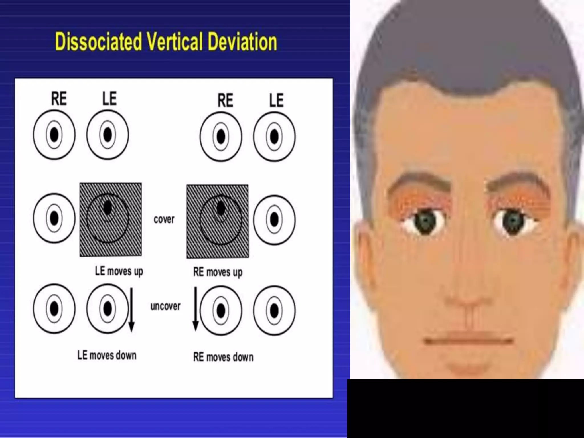 Examination of a case of strabismus | PPTX