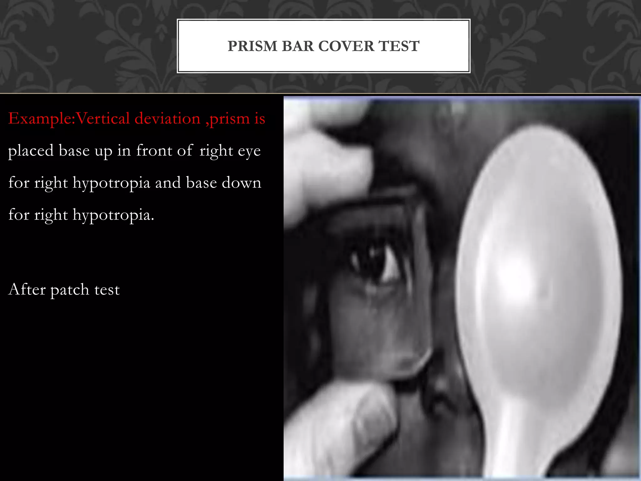 Examination of a case of strabismus | PPTX