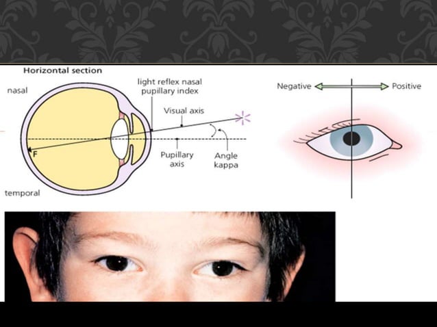 Examination of a case of strabismus | PPTX | Eye and Vision Conditions ...
