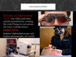 Examination of a case of strabismus | PPTX