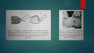EXAMINATION OF A LUMP OR A SWELLING.pptx