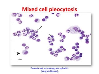 Examination of cerebrospinal fluid presentation mode | PPSX