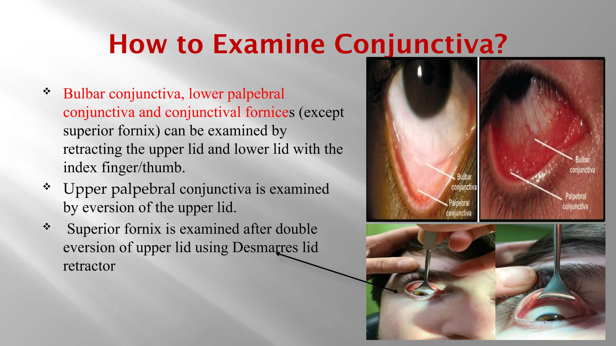 Examination of Conjunctiva.Abnormalities .pptx