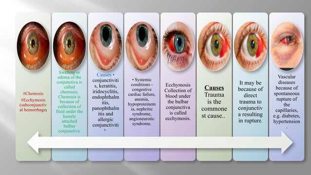 Examination of Conjunctiva.Abnormalities .pptx