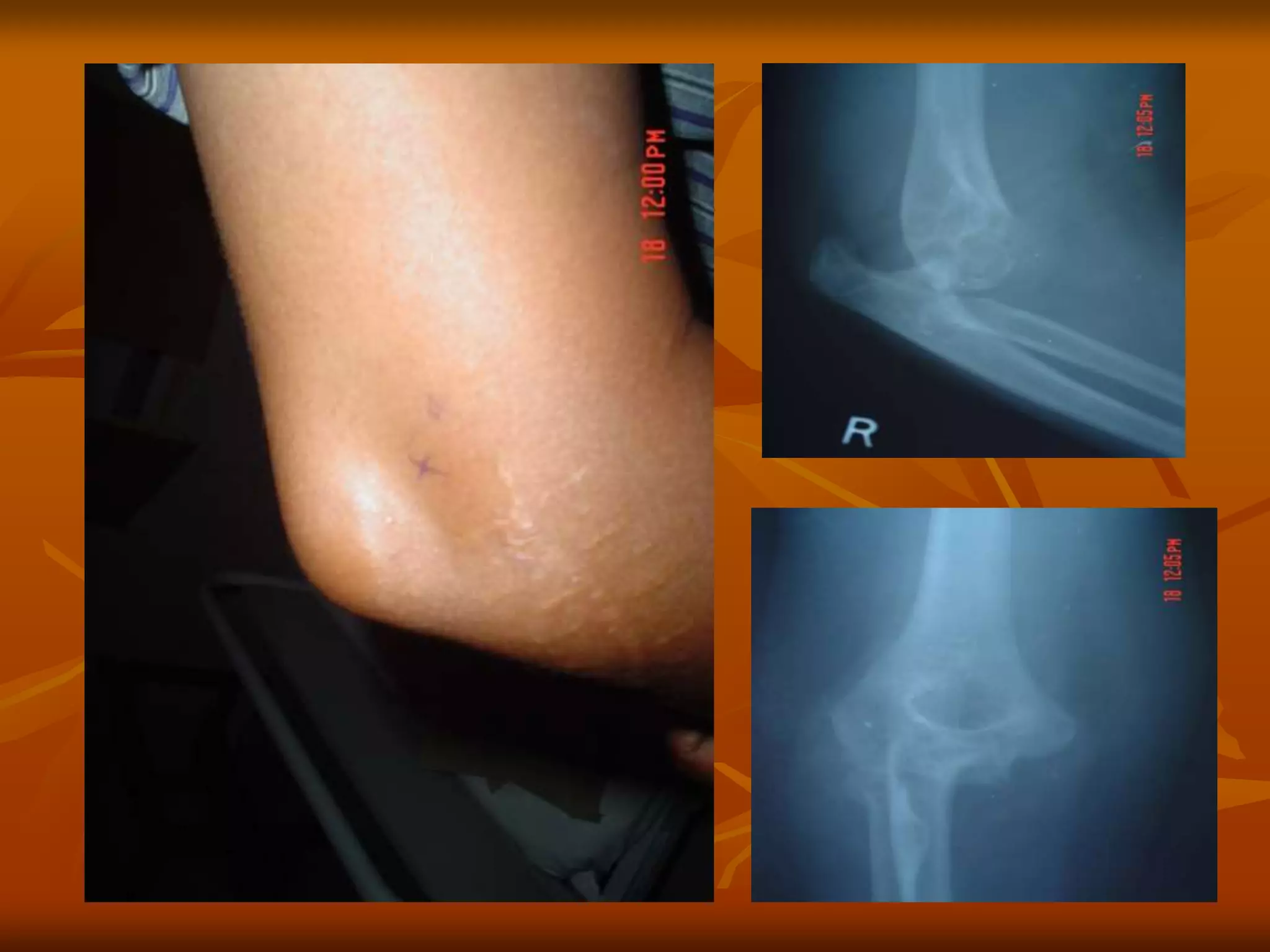 Examination of elbow | PPT