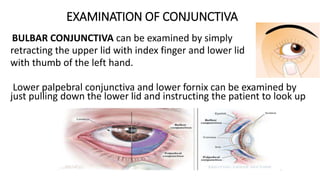 Conjunctiva Inspection