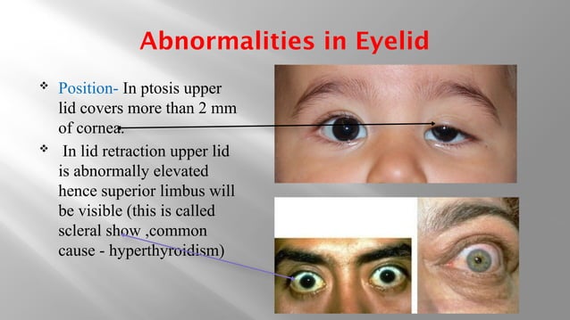 Examination of eyelids.pptx, Normal,abnormalities. | PPTX