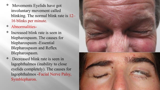 Examination of eyelids.pptx, Normal,abnormalities. | PPTX