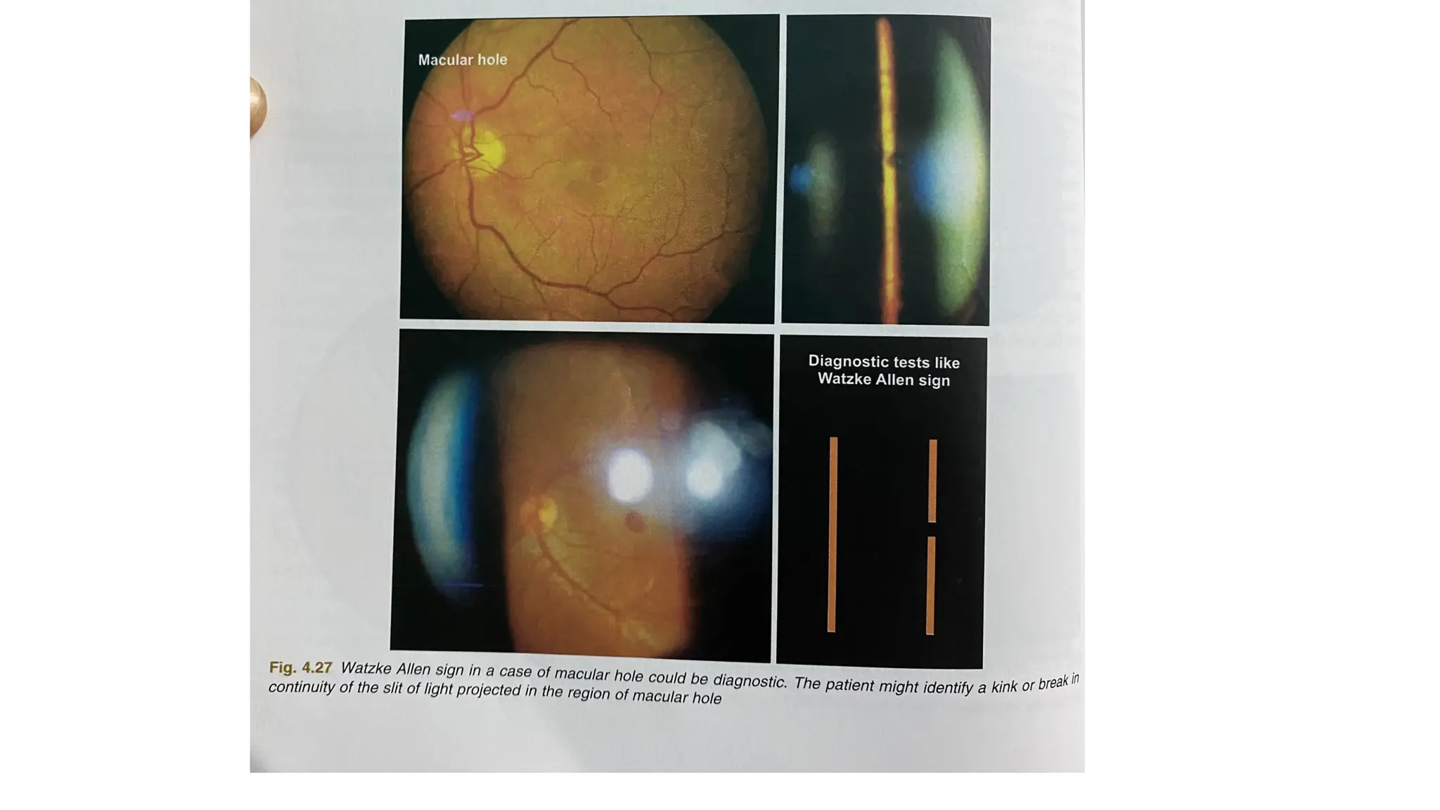 EXAMINATION OF FUNDUS and its description | PPT