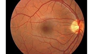 EXAMINATION OF FUNDUS and its description | PPT