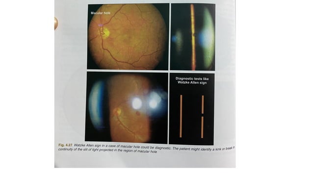 EXAMINATION OF FUNDUS and its description | PPT