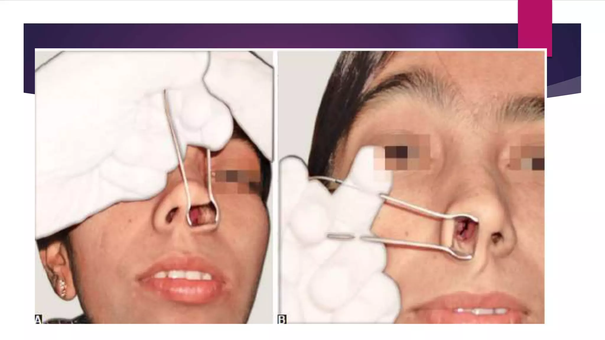 Examination of nose | PPTX