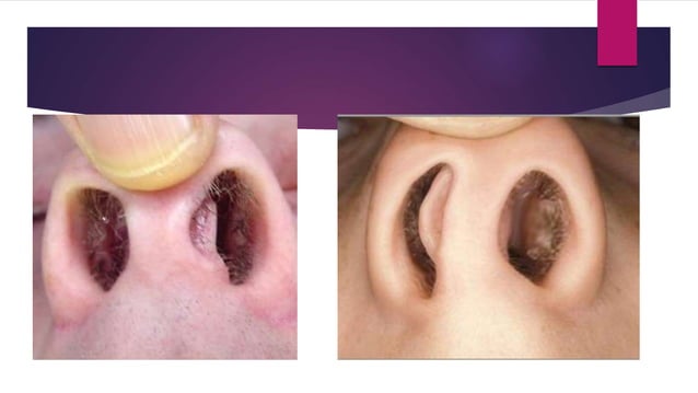 Examination of nose | PPTX