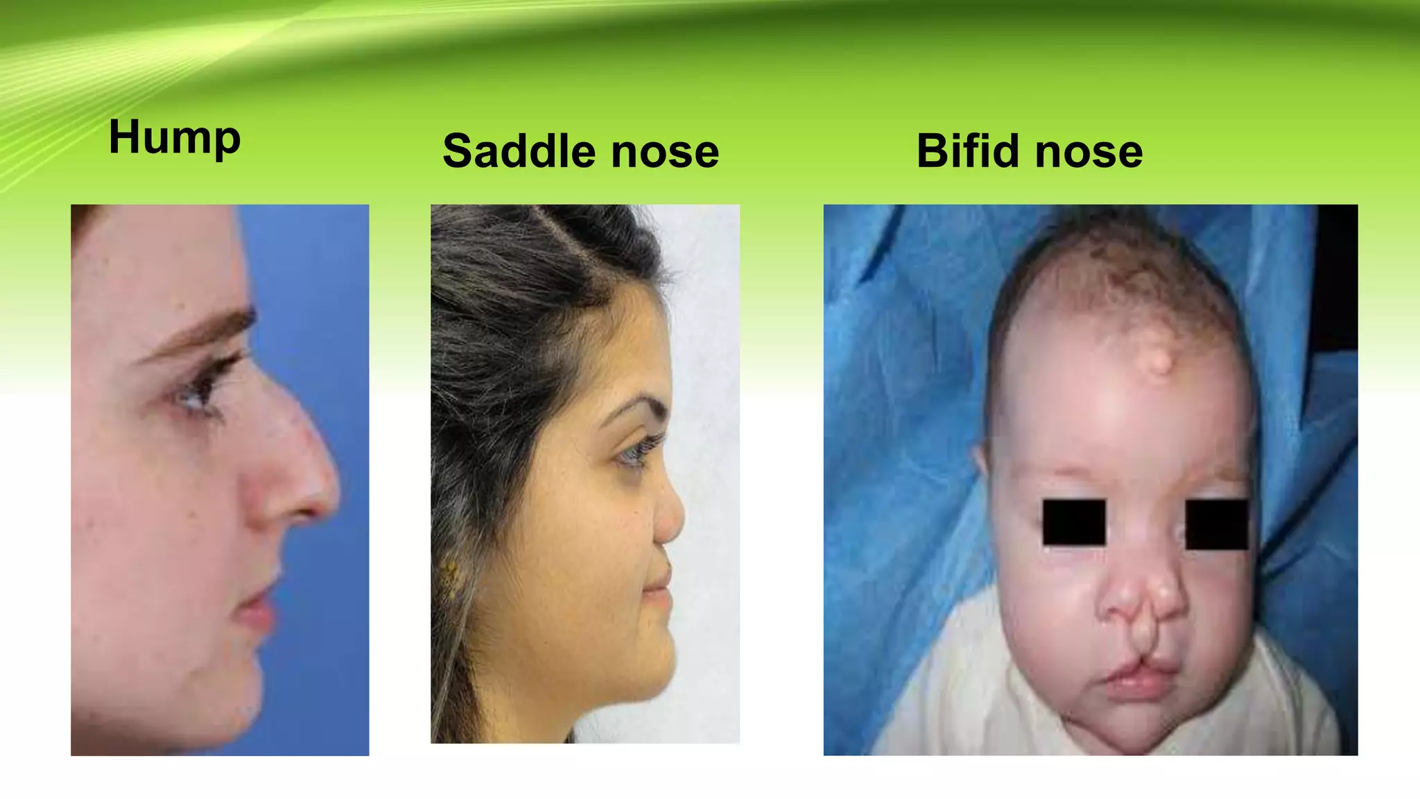 Examination of nose | PPTX