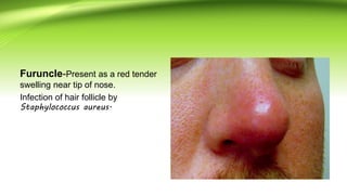 Examination of nose | PPTX