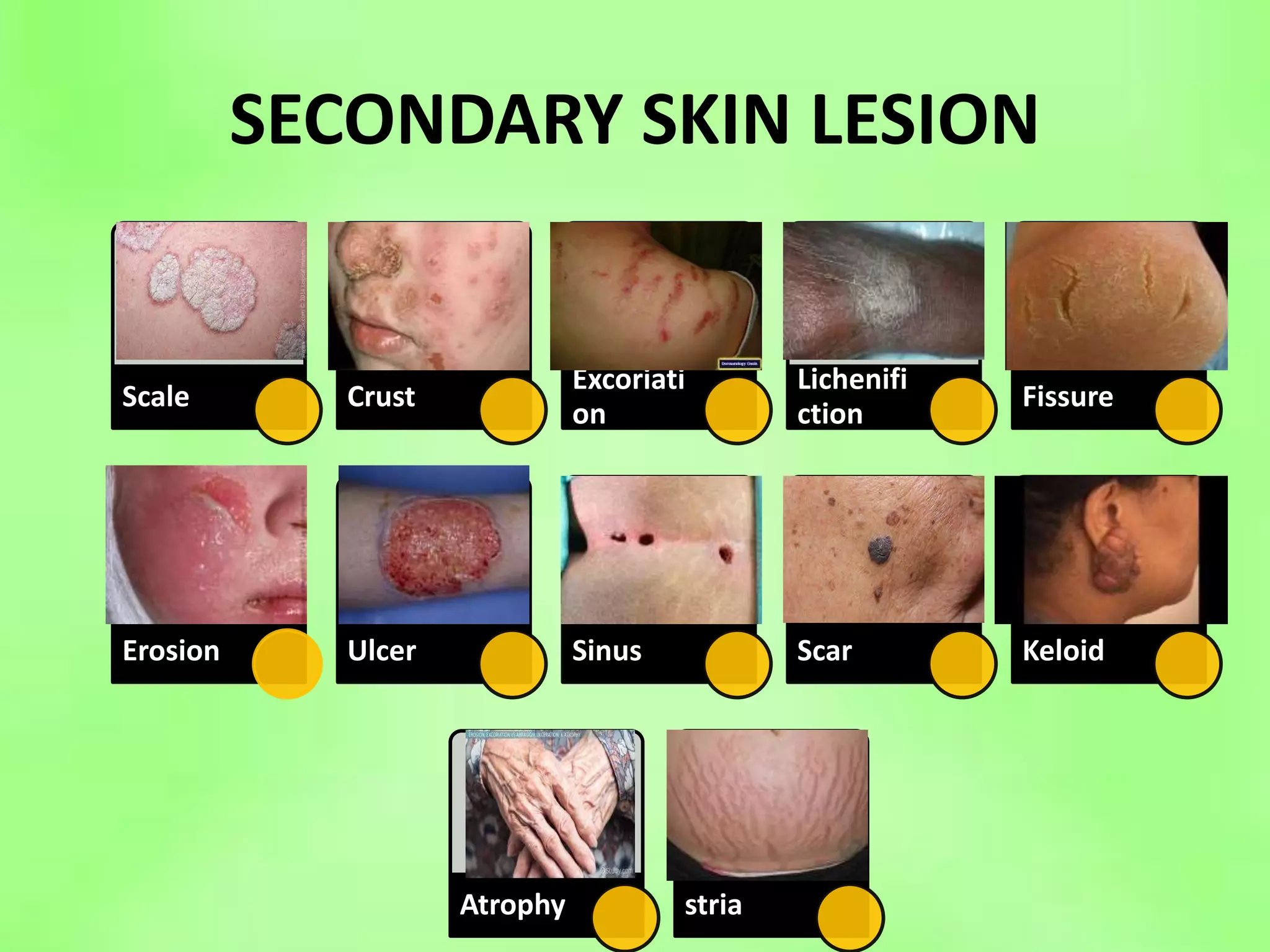 Examination of secondary skin lesion and its applied aspects | PPTX
