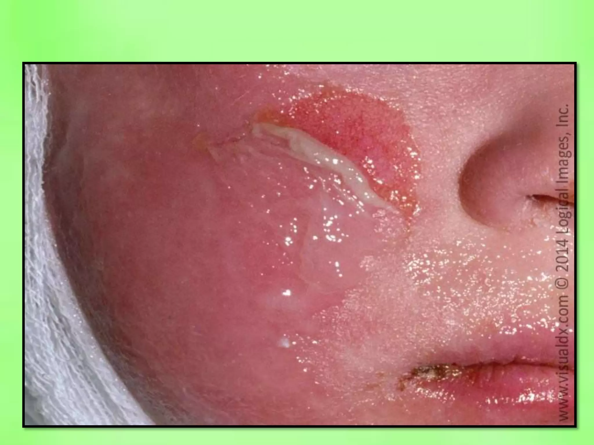 Examination of secondary skin lesion and its applied aspects | PPTX