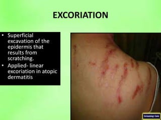 Excoriation Skin Lesion