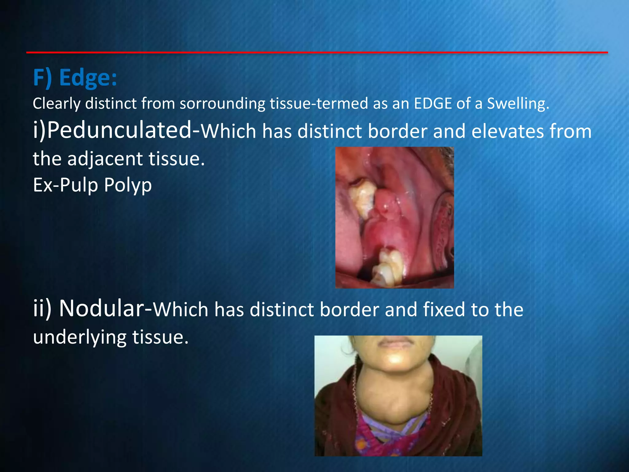 Examination of Swelling | PPTX