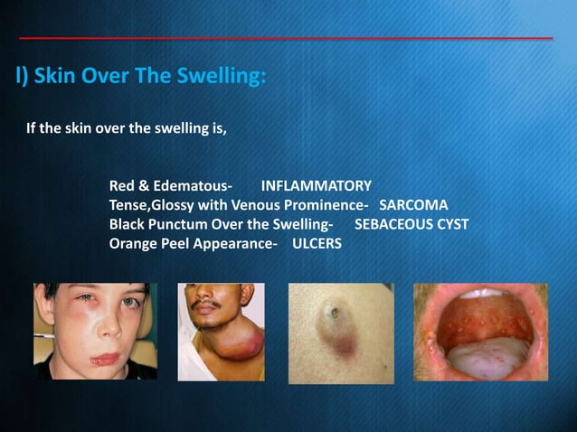 Examination of Swelling | PPTX