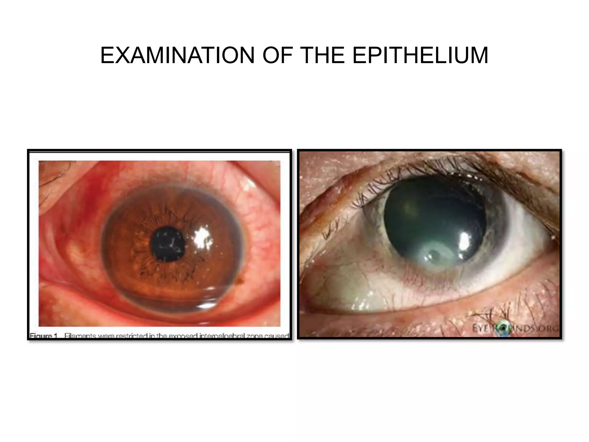 Examination of the cornea by Dr. Iddi Ndyabawe | PPTX
