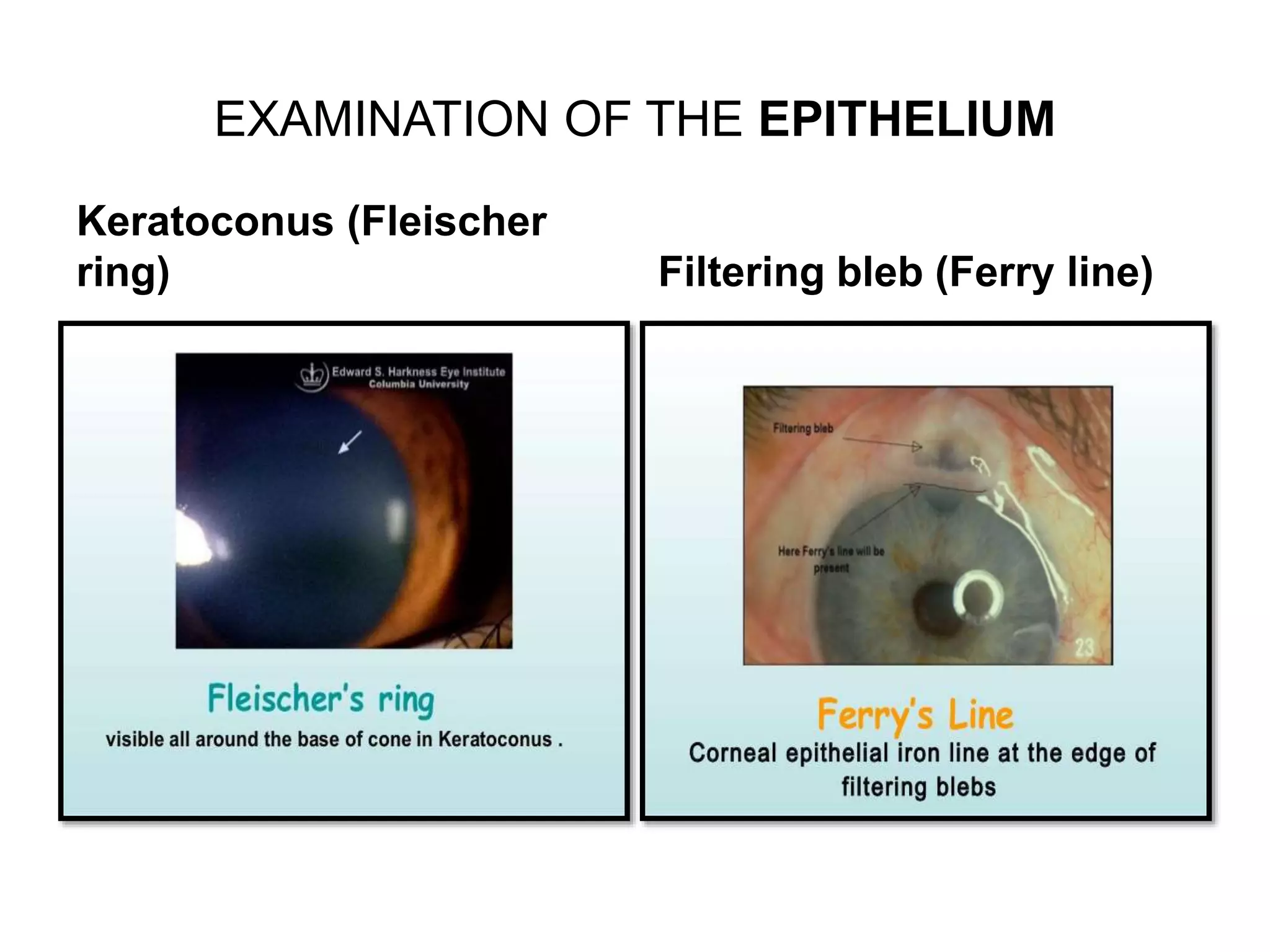 Examination of the cornea by Dr. Iddi Ndyabawe | PPTX