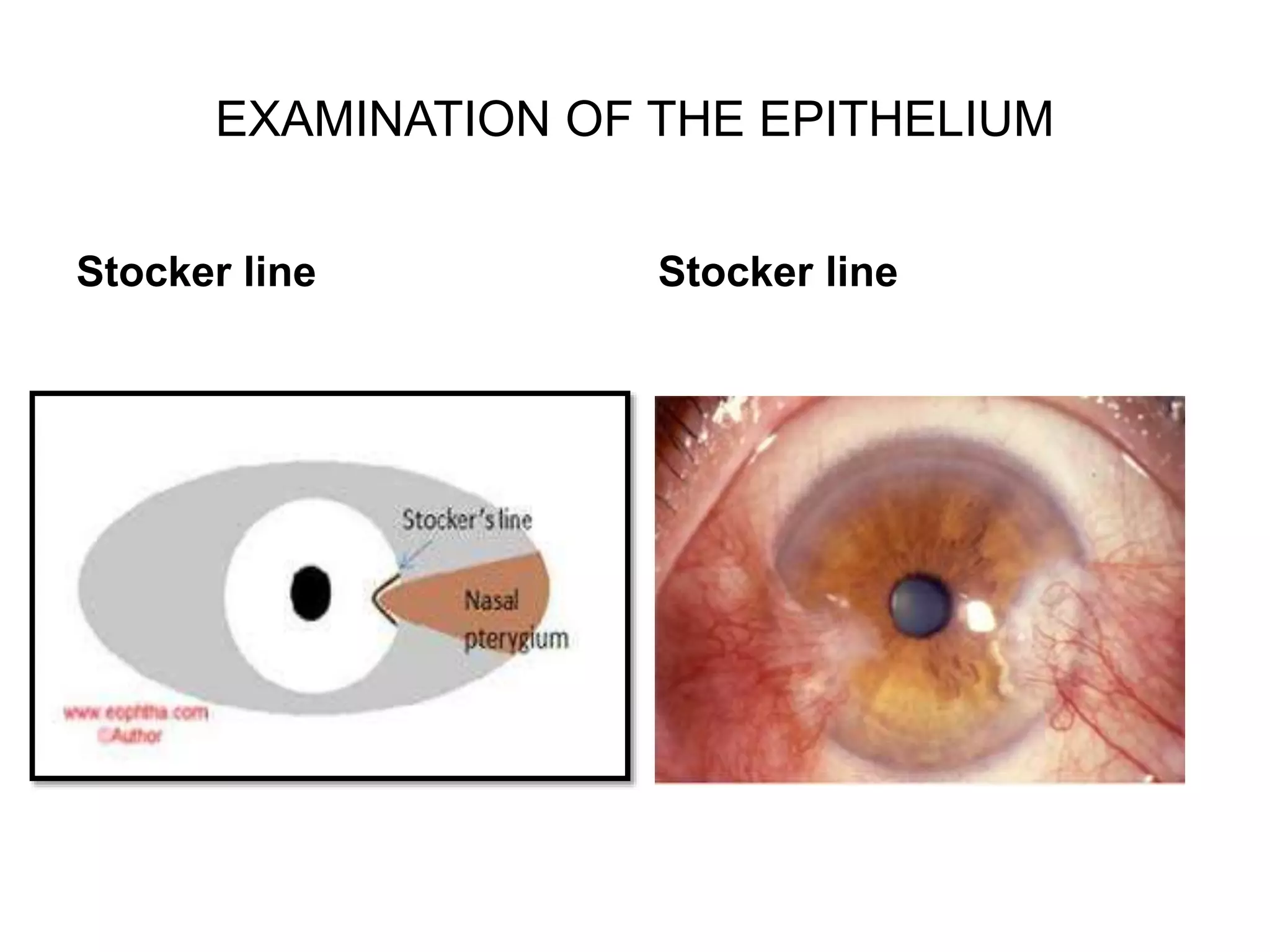 Examination of the cornea by Dr. Iddi Ndyabawe | PPTX