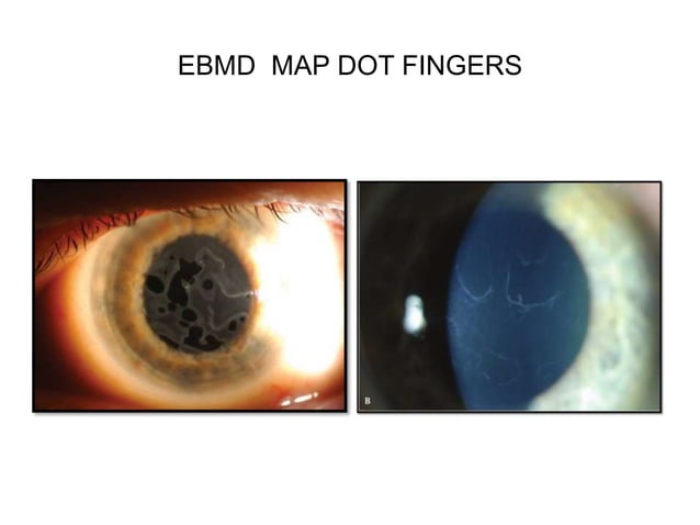Examination of the cornea by Dr. Iddi Ndyabawe | PPTX