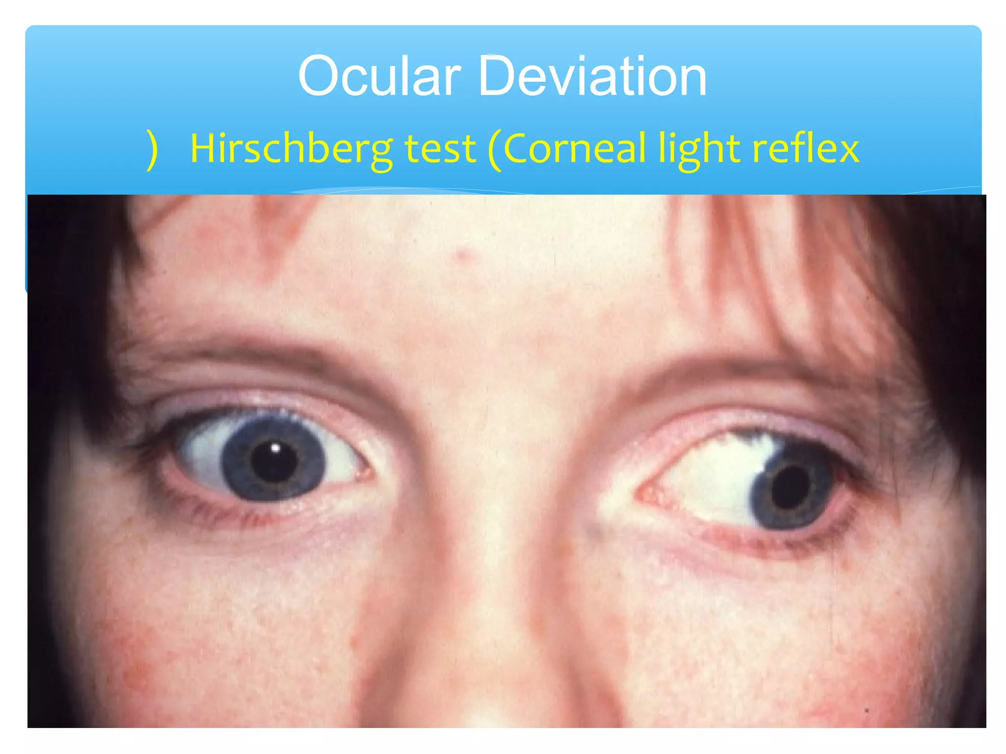 Cinical examination of the eye | PPT