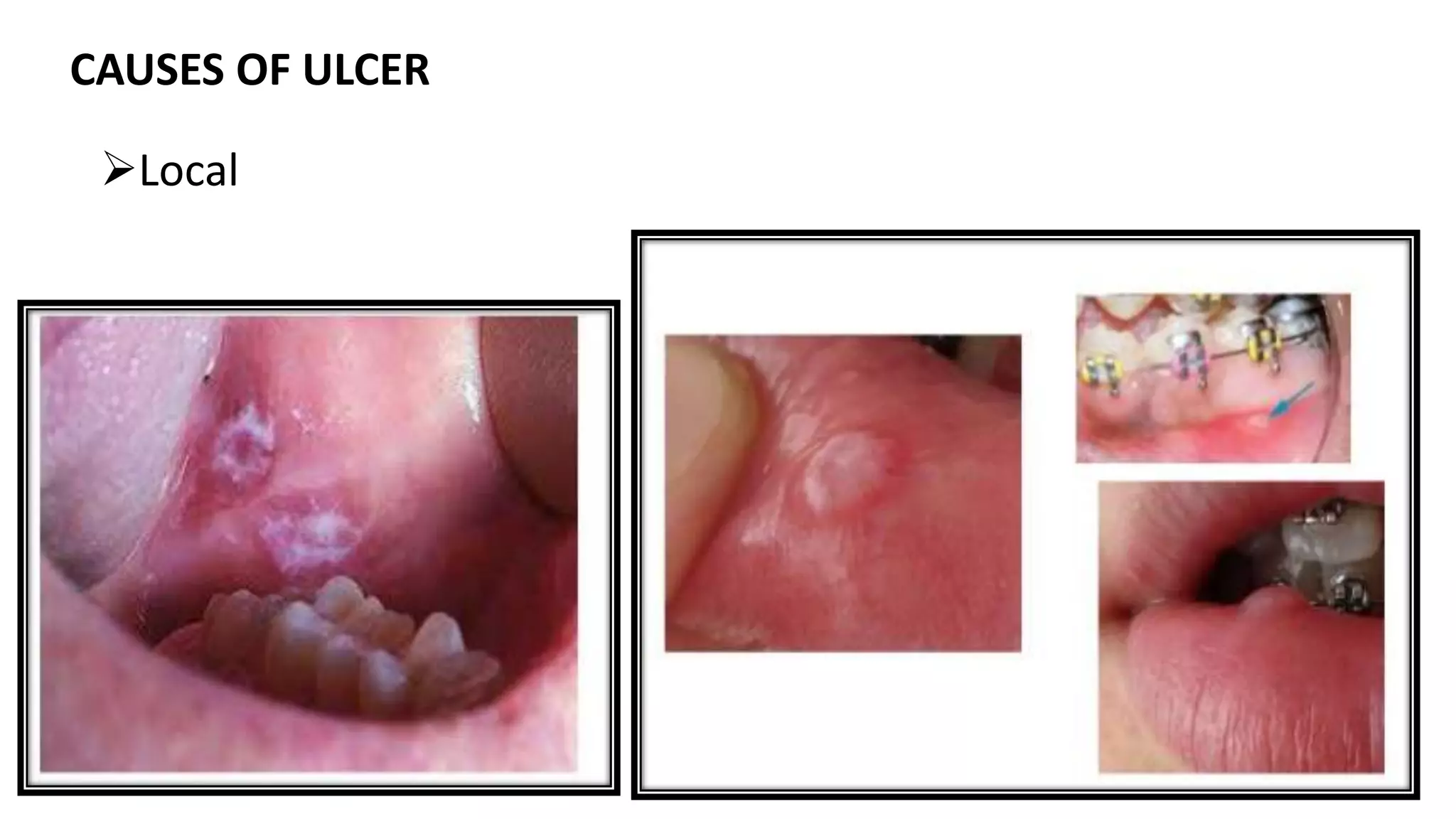 Examination of ulcer | PPTX