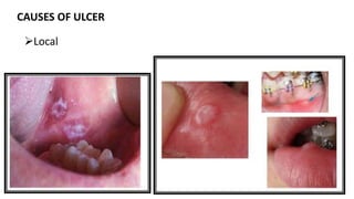 Examination of ulcer | PPTX